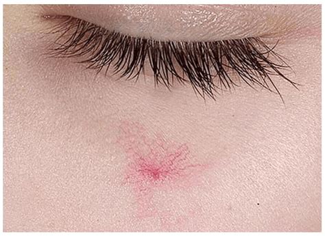 Красные пятна на лице что это и как убратьКрасные пятна на лице что это и как убрать