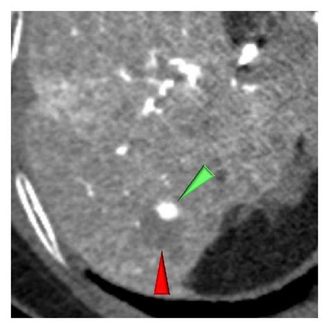 A High Grade Dysplastic Nodule Red Arrowheads Harboring A Progressed