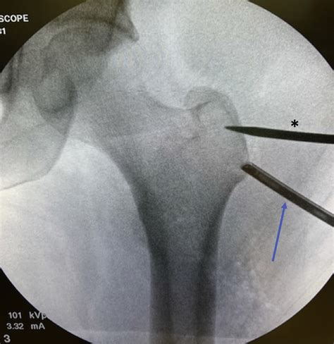 This Fluoroscopic Anteroposterior Image Of A Left Hip Shows The Download Scientific Diagram