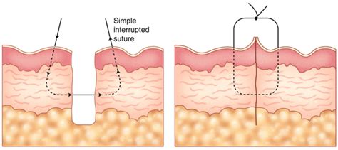 Post-excisional Wound Closure Chapter for Rural Surgeons | Anesthesia Key