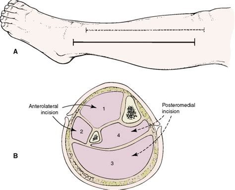骨科筆記 Fasciotomy