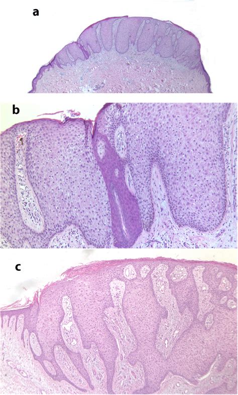 Clear Cell Acanthoma A Series Of 70 Cases Actas Dermo Sifiliográficas