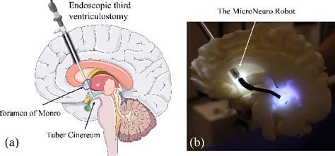 Figure 1 From Design And Visual Servoing Control Of A Hybrid Dual Segment Flexible Neurosurgical