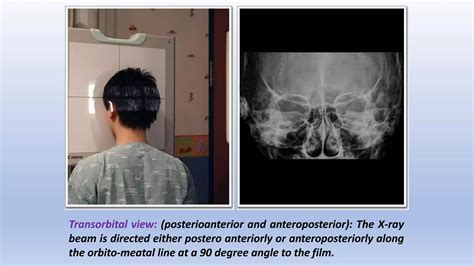 Hrct Temporal Bone Pk1 Ppt Pptx