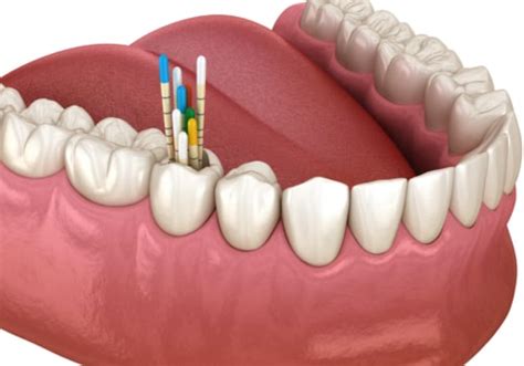 Understanding Endodontic Pluggers And Their Uses