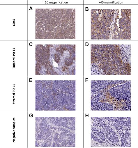 Clinical And Prognostic Implications Of Cd47 And Pd L1 Expression In Surgically Resected Small