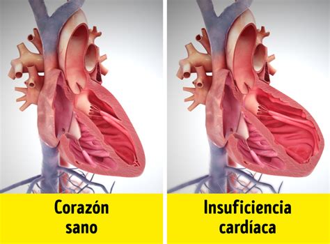 ¿sabes Que Es La Insuficiencia Cardíaca Cómo Se Presenta Y Cuales Son