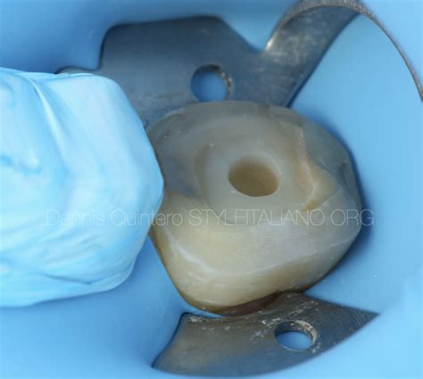 Intentional Replantation In Distal Root Defect Made By Wisdom Tooth Style Italiano Endodontics