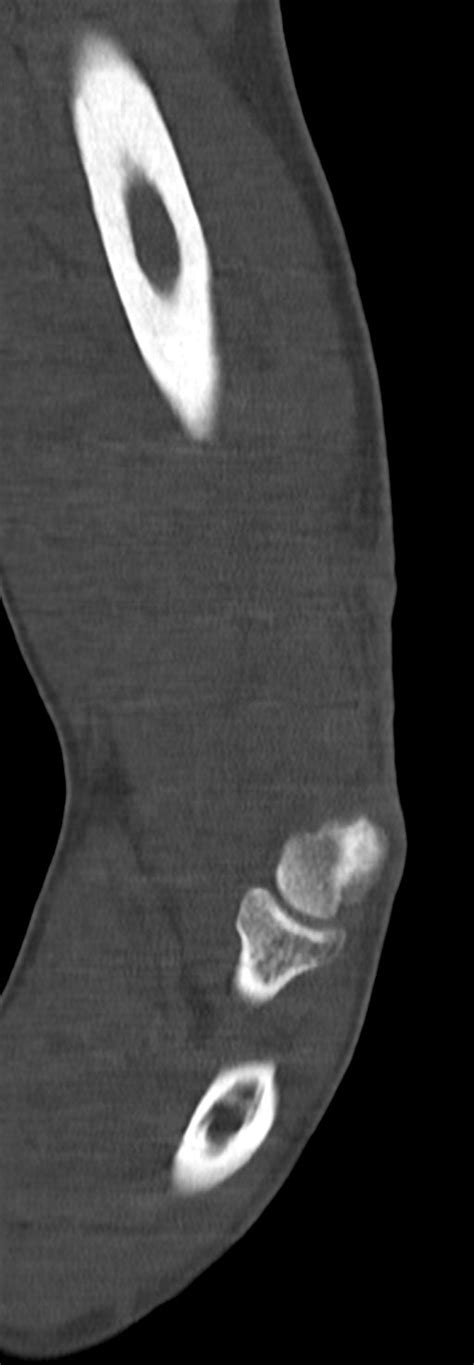 Chronic Osteomyelitis Of The Distal Humerus Radiopaedia 78351 90971