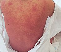 An Erythematous Pustular Rash On The Torso And Limbs Medicine Today