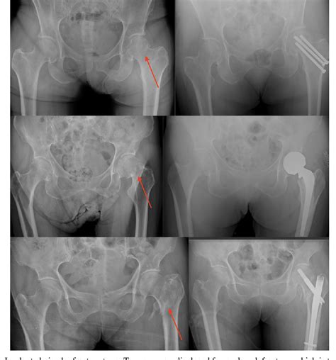 Figure 1 From Automatic Hip Fracture Identification And Functional Subclassification With Deep