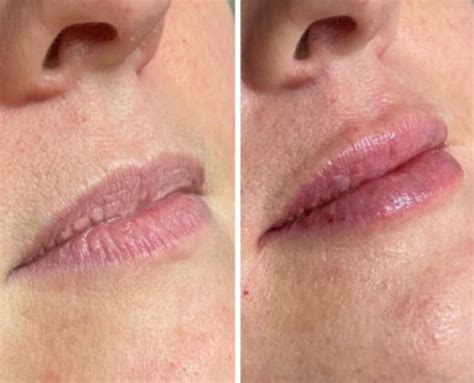 Langley Platelet Rich Plasma Or Hair Restoration The Naked Truth