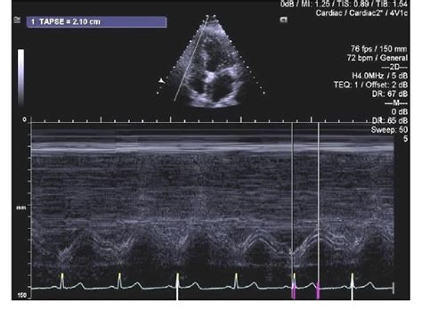 Method Of Tapse Measurement Download Scientific Diagram