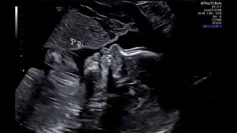 [임신21주6일] 일산차병원 정밀초음파 후기와 꿀팁 네이버 블로그