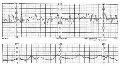 Abruption Pattern Obgyn Nursing
