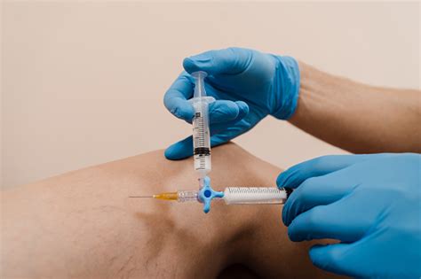 혈관 기형을 치료하기 위해 다리의 정맥류 또는 거미 정맥에 주사하는 경화 요법 혈관 외과의 사는 경화 요법 절차를 위해 여성