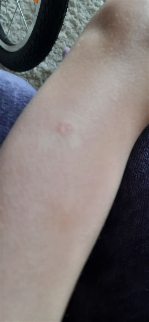 Пятнышко у ребенка Вопрос детскому дерматологу 03 Онлайн