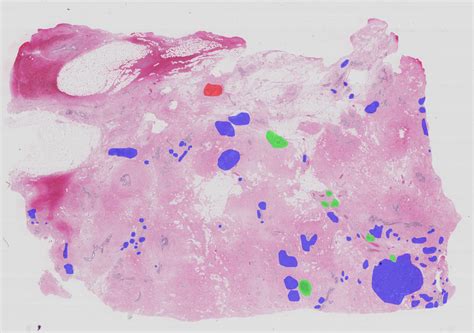 Segmentation Of Two Wsis From The Iciar 2018 Bach Challenge Colors Download Scientific Diagram