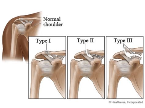 Shoulder Joint Conditions Flashcards Quizlet