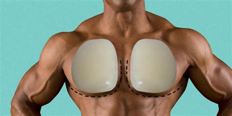 Claudia Henock On Linkedin On Patience Hard Work And… Pec Implants