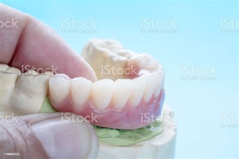 치과 임플란트 작업이 완료되고 사용할 준비가 되었습니다 Stem 주제에 대한 스톡 사진 및 기타 이미지 Stem 주제 건강