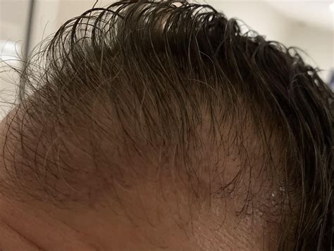3 Months Progress After Ht R Hairtransplants