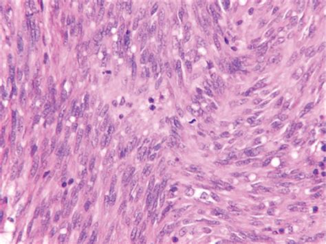 Postoperative Pathology Confirmed The Presence Of Gastric Stromal Download Scientific Diagram