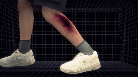 Symptoms And Effects Of Necrotizing Fasciitis Youtube