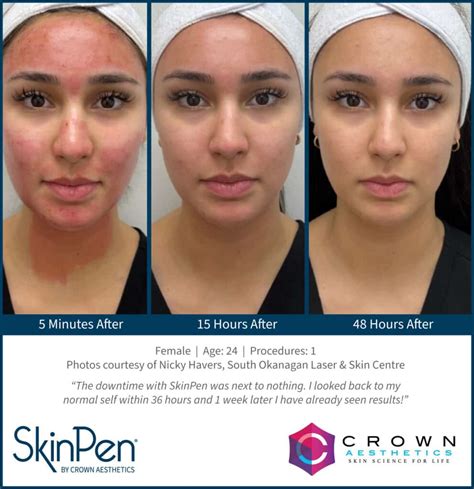 Results Skinpen Precision By Crown Aesthetics