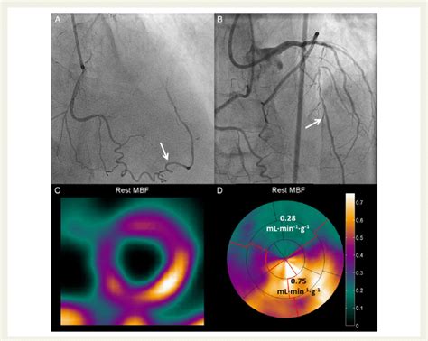 Illustration Of A Patient With Severe Reduced Perfusion Of The Anterior Download Scientific
