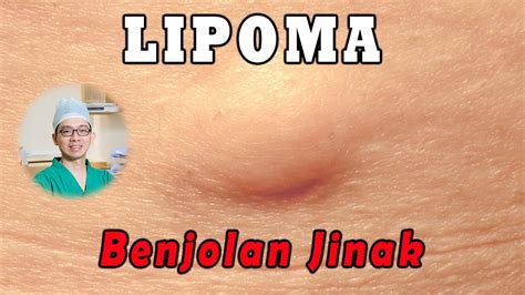 Lipoma Tumor Jinak Benjolan Lunak Youtube