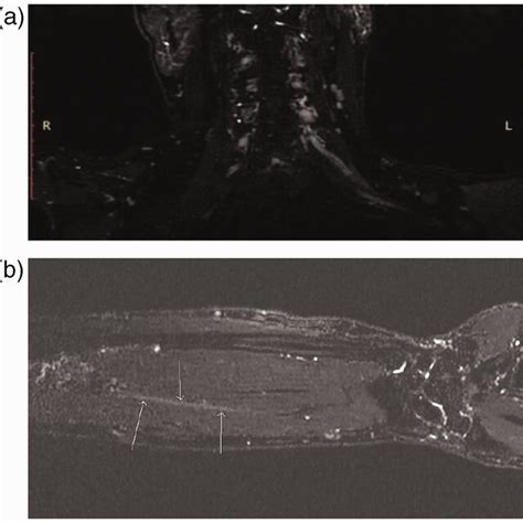 High Resolution Magnetic Resonance Imaging Of The Cervical Nerves A Download Scientific