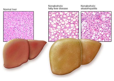 Fatty Liver Disease And Nonalcoholic Causes Symptoms And Treatments