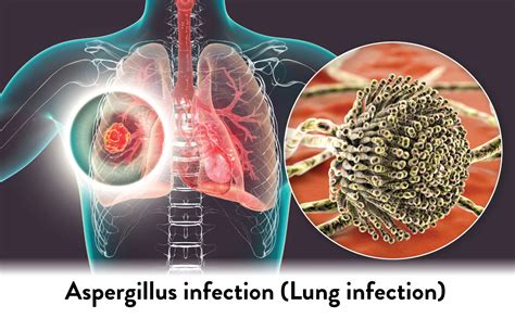 Aspergillus Lung
