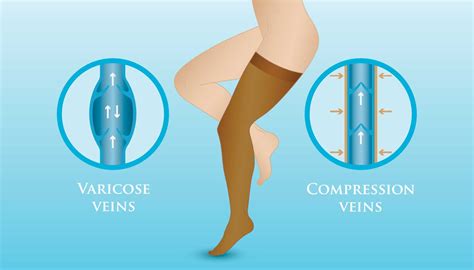 Compression Stockings For Varicose Veins All You Need To Know Dr Jathins Vein Center