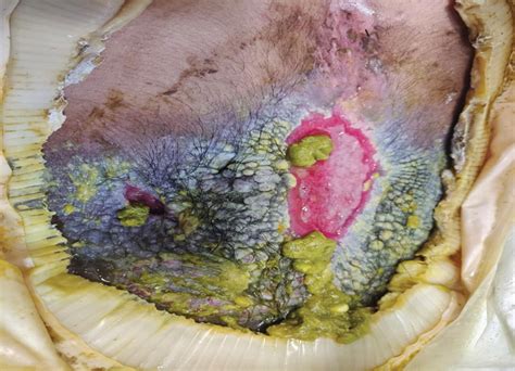 Pseudoverrucous Papules And Nodules Around A Surgical Stoma Mdedge