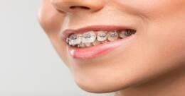 Dente Encavalado Quais Possíveis Tratamentos Allegra Odontologia
