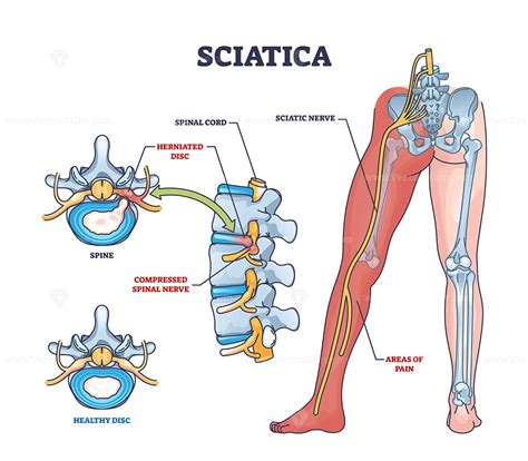 Sciatica As Symptom From Herniated Disc And Spinal Nerve Outline