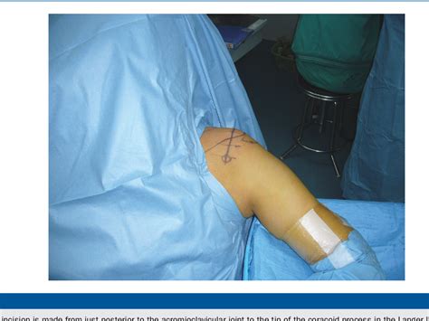 Figure 3 From Proximally Based Conjoined Tendon Transfer For