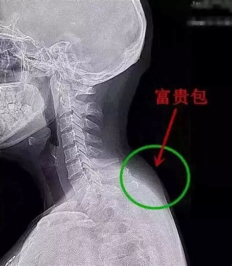 小孩子颈椎富贵包 颈椎富贵包 颈椎富贵包 第5页 大山谷图库