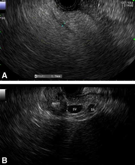 Eus In Patients With Surgically Altered Upper Gi Anatomy