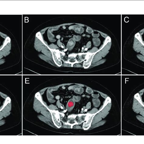 different ct phase images used for radiomics analysis a c images