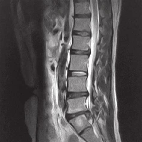 What Is Disc Desiccation At L5 S1 At Sarah Fox Blog