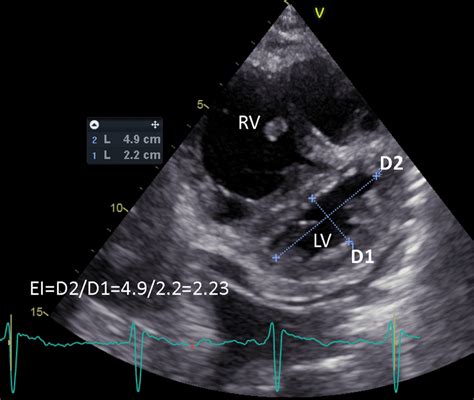 Measurement Of Echocardiography Derived Eccentricity Index Ei At