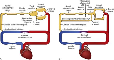 Endoscopic Third Ventriculostomy Neupsy Key