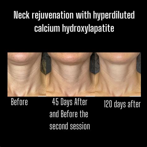Neck Rejuvenation With Hyper Diluted Radiesse In Portland Or — Dr Heather Friedman Nd Lac