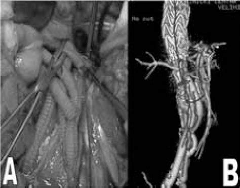 A Reconstruction Of Aortoiliac Segment And Revascularization Of All