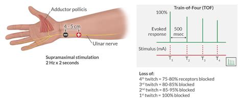 Understanding Postoperative Residual Block And Train Of Four Apex
