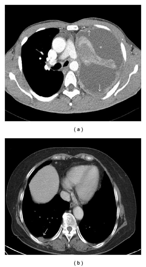 Pleural Metastases With Large Amount Of Effusion ∗ And Diffuse