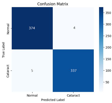 Hybrid Deep Learning Model For Cataract Diagnosis Assistance